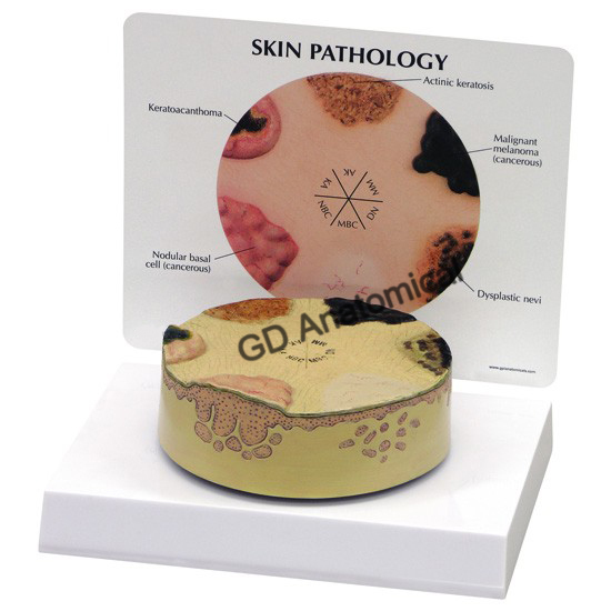 Skin Cancer