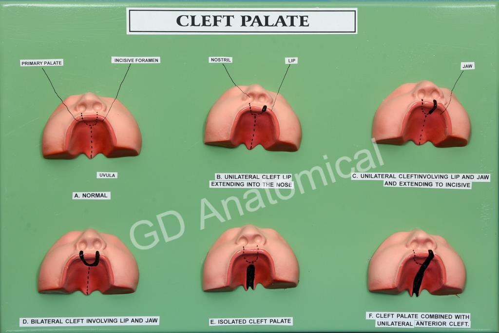 Cleft Palate Model