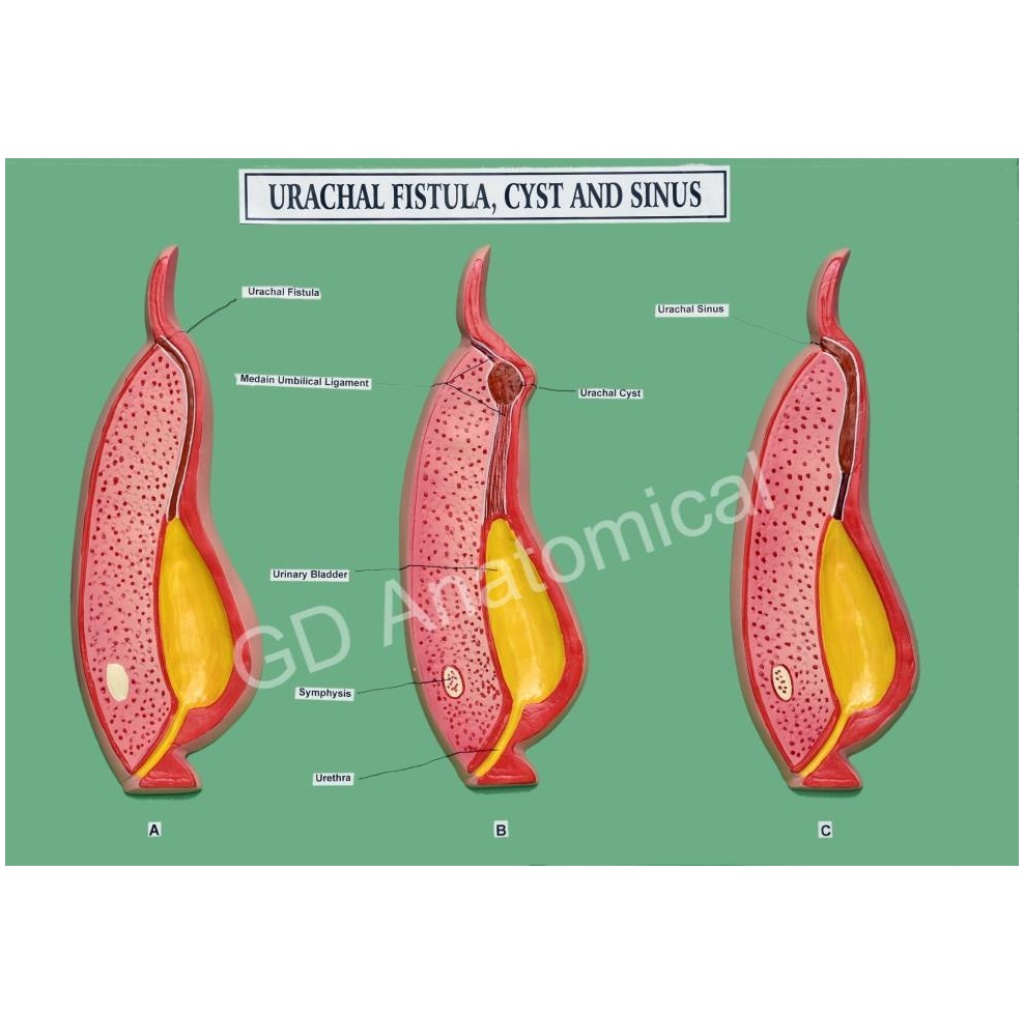 Urachal Fistula, Cyst And Sinus Model
