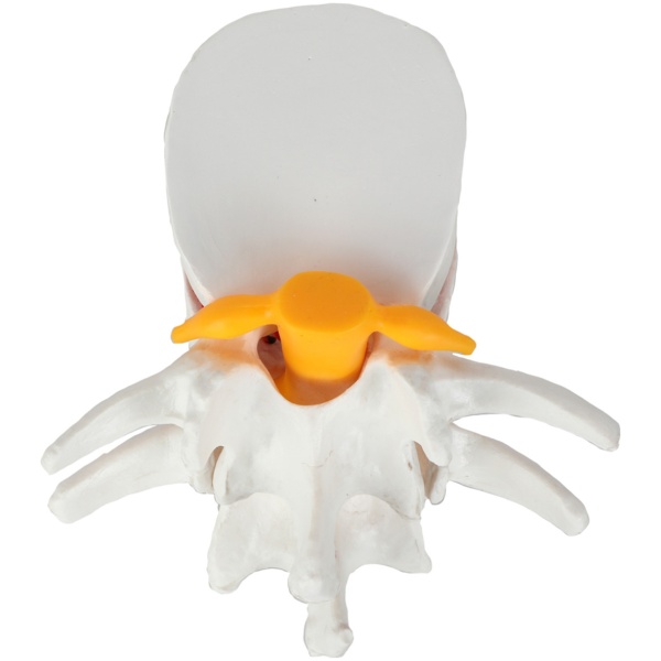 Human Lumbar Herniating Disc Demonstration Anatomy Model