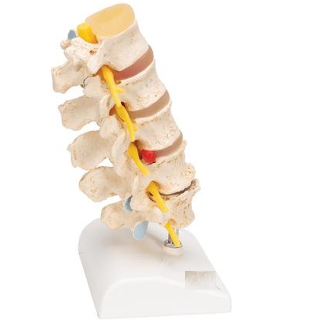 Stages Of Disc Prolapse And Vertebral Degeneration Anatomy Model