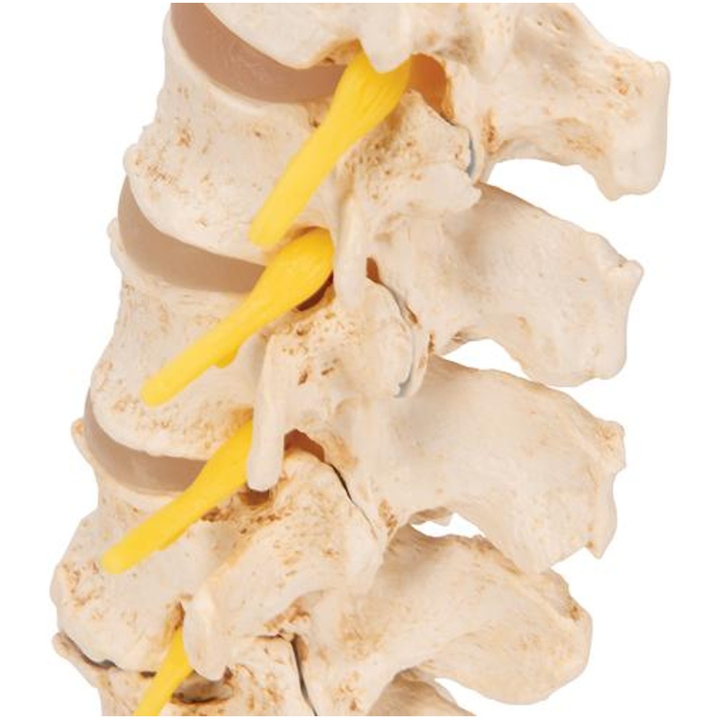 Stages Of Disc Prolapse And Vertebral Degeneration Anatomy Model